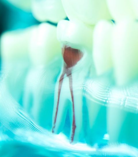 Root Canals & Tooth Extraction in Surrey | Evergreen Dental Centre